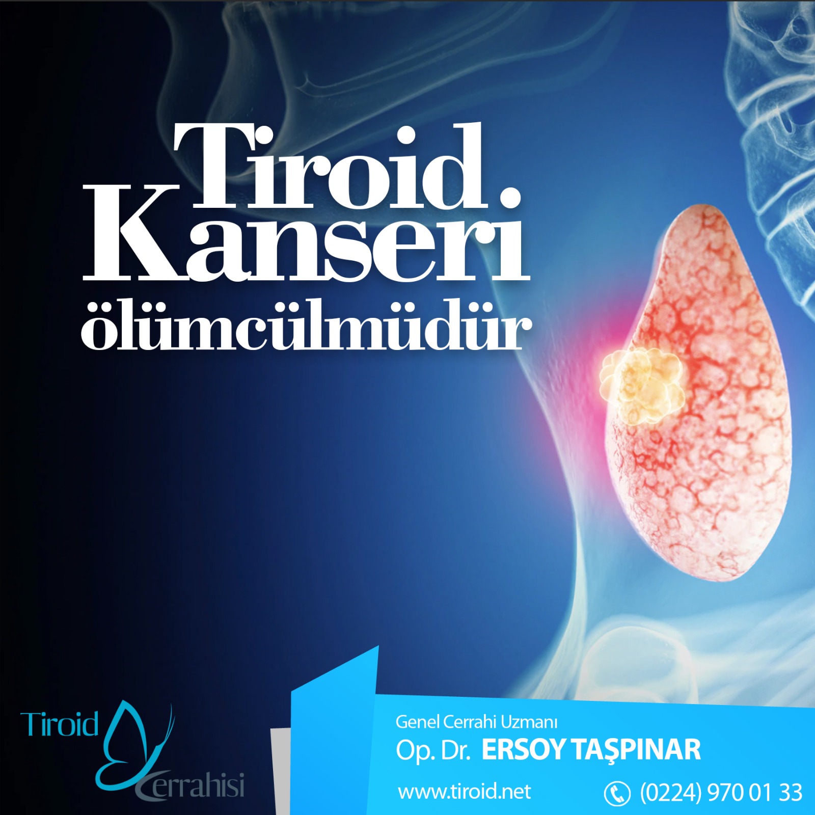 Tiroid kanseri ölümcül müdür ? – Tiroid ve Guatr Cerrahisi – Op. Dr ...